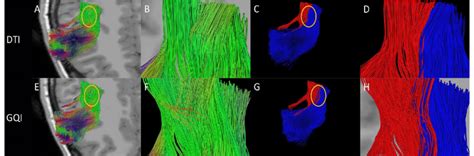 A Image Of Arcuate Fasciculus And The Supplementary Motor Area Sma