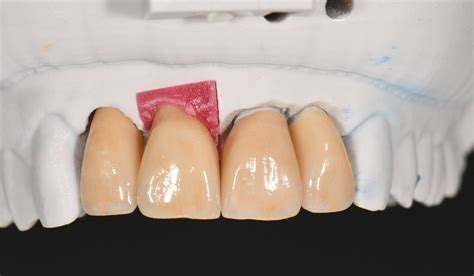 Monolithic Multilayer Zirconia Crowns In The Esthetic Zone