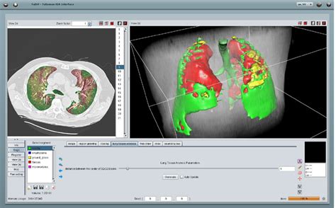 Segmentation Of The Lung Tissue Using Yadiv A Lung Tissue Analysis