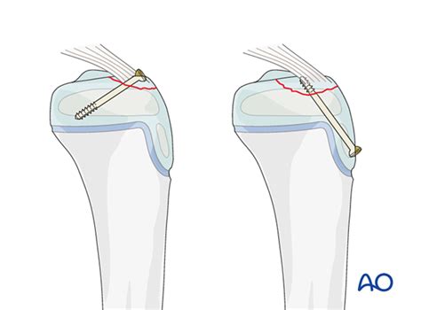 Open Reduction Screw Fixation For Avulsion Of The Tibial Spine