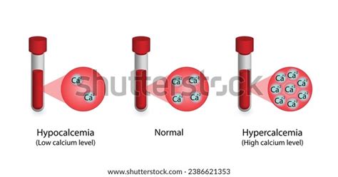 High Calcium Levels Photos And Images Shutterstock