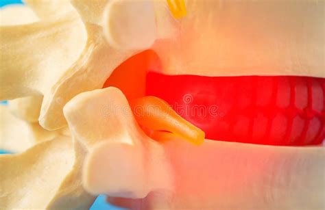 Red Inflamed Spine With A Compressed Nerve Root Close Up Neuralgia And Radiculitis In Diseases