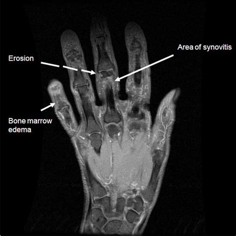 Erosive Osteoarthritis Image Radiopaediaorg