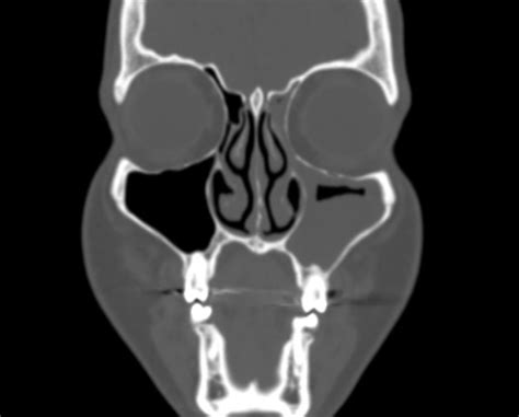 축농증부비동염 Sinusitis 3 만성 부비동염chronic Sinusitis 네이버 블로그