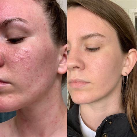 Dermatitis On Face How To Get Rid At Savannah Cawthorne Blog