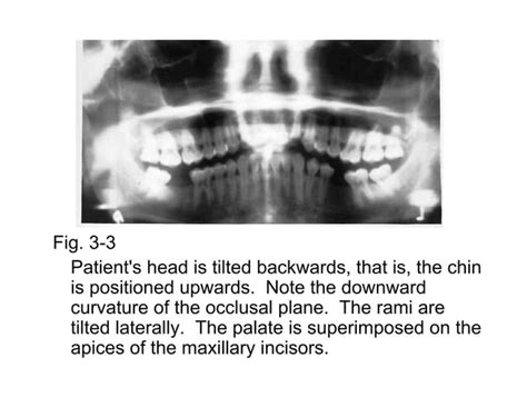 Positioning Errors In Panoramic Radiography Ppt Positioning Errors In Panoramic Radiography Ppt