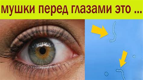 Мушки перед глазами Как избавиться Youtube