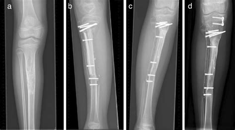 Adamantinoma In The Proximal Tibia Of A 10 Year Old Girl A Status Download Scientific