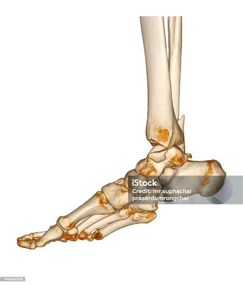 Ct 스캔 발목과 발 또는 발목 관절의 컴퓨터 단층 촬영 및 발 3d 볼륨 골절된 경골과 비골을 보여주는 렌더링 이미지 3d 스캔에 대한 스톡 사진 및 기타 이미지 Istock