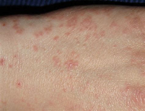 Scabies Rash What Is A Scabies Rash