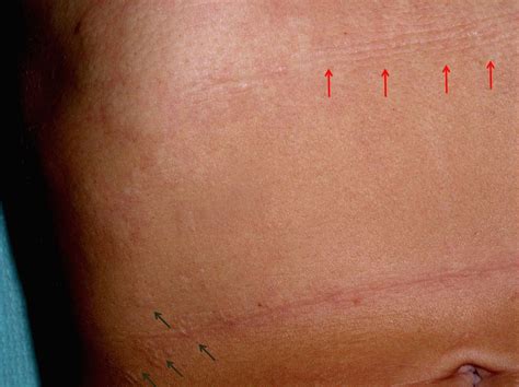 Elastólisis De La Dermis Media Piel Formación Continuada En Dermatología