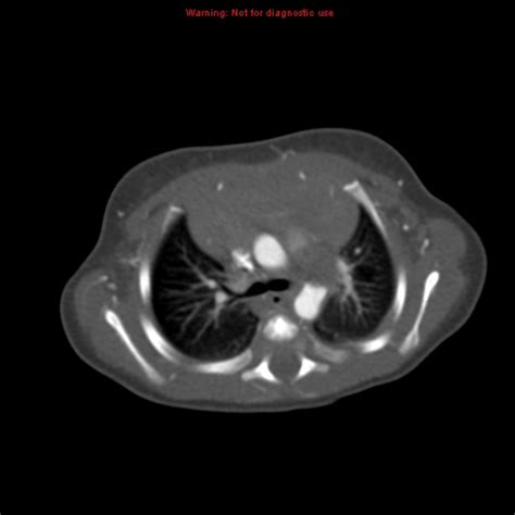 Aortic Ductus Diverticulum Radiopaedia 8339 9180 A Nc Commons