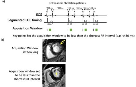 Adjustment To The Data Acquisition Window For Patients With Atrial