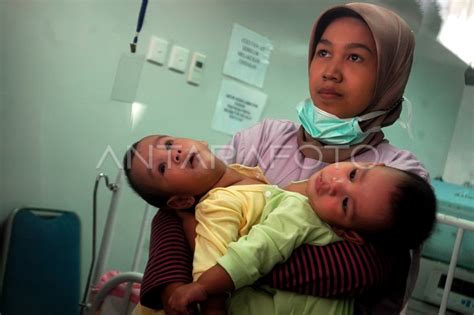Kembar Siam Antara Foto