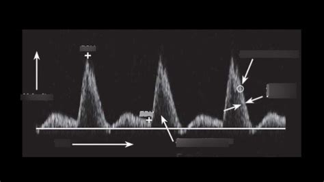 Doppler Spectral Analysis Diagram Quizlet