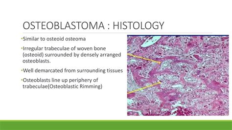 Benign Bone Forming Tumors Pptx