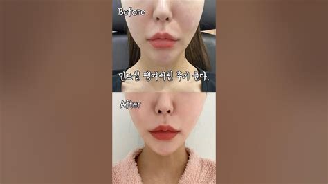 민트실 땡겨버린 후기 민트실리프팅 리프팅시술 실리프팅 리프팅레이저 실리프팅후기 실리프팅전후 실리프팅부작용