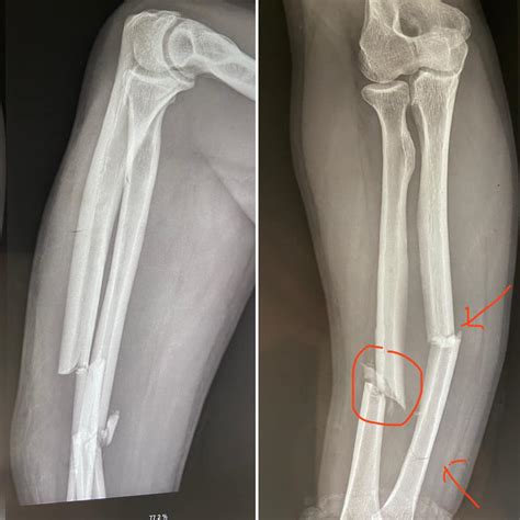 Radius Shaft With Segmental Ulna Fracture Segmental Fractures Are