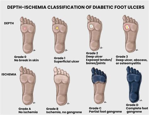 Classification Of Wounds Hyperexcision