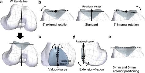 Schemas Indicating Femoral Component Settings In Patellofemoral Download Scientific Diagram