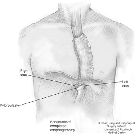 Cholecystojejunostomy And Choledochohepaticojejunostomy Basicmedical Key