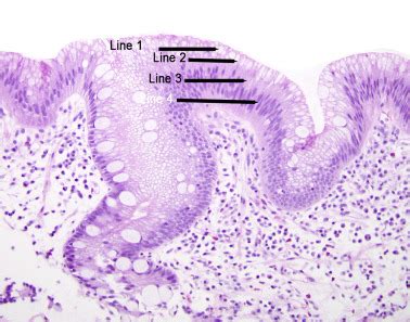 References In Barretts Esophagus A Comprehensive Review And Update