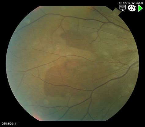 Choroidal Hemorrhage From Hypertensive Choroidopathy Retina Image Bank