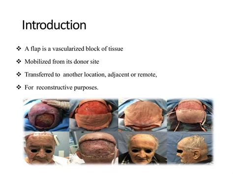 Flaps And Its Classification Pptx