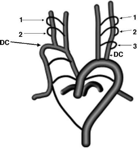 The Right Ductus Caroticus Arrow The Right Seventh Intersegmental