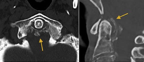 Cervical Ct Dependent Diagnosis Of Crowned Dens Syndrome In Calcium Pyrophosphate Dihydrate