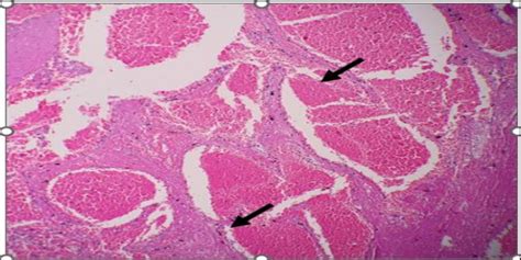 Polypoid Lesion Harboring Dilated Thinwalled Blood Vessels Filled With