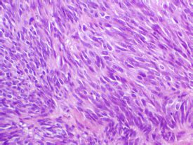 Pathology Analyses For GIST GIST Support International