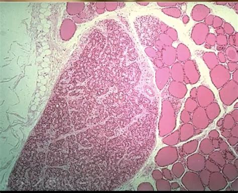 Parathyroid Pathology Flashcards Quizlet
