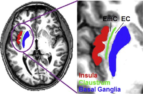 E Axial Mri Scan Highlighting The Region Of The Extreme Capsule Red ¼