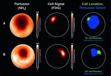 polar map analysis of perfusion defect and early retention of