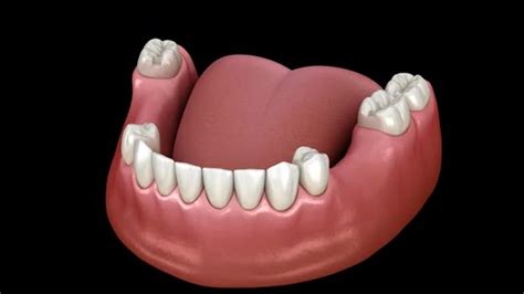 Removable Partial Denture Mandibular Prosthesis Backgrounds Motion