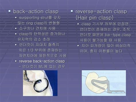 Reverse Action Clasp Rpd At Paul Boldt Blog