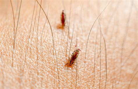 Lice Close Up Face