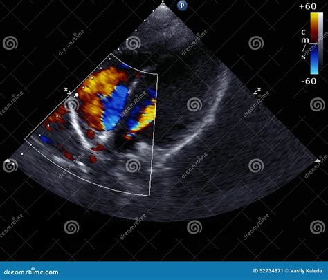 Doppler Echocardiography Stock Image Image Of Atrium 52734871