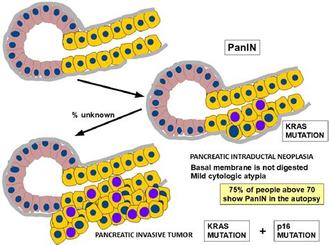 Figure 9 From Genetic Signature Of Human Pancreatic Cancer And