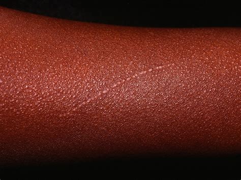 Lichen Nitidus Causes Symptoms Diagnosis Cure And Treatment