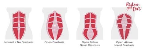 Diastasis Recti Surgery Guide Insights From Restore Your Core