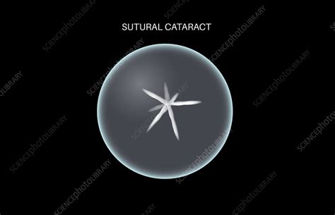 Cataract Eye Disease Illustration Stock Image F0436897 Science