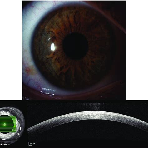 A Biomicroscopic Photograph Top Panel And Anterior Segment Optical Download Scientific