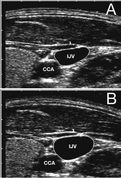 External Jugular Vein Ultrasound