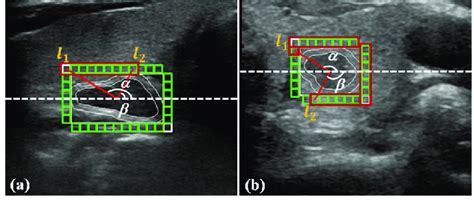 Relative Position Features Between The Nodule And The Thyroid Tissue Download Scientific
