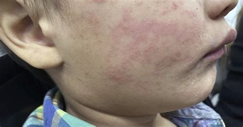 스치기만 해도 감염률 90 이 질환 전 세계 유행 조짐