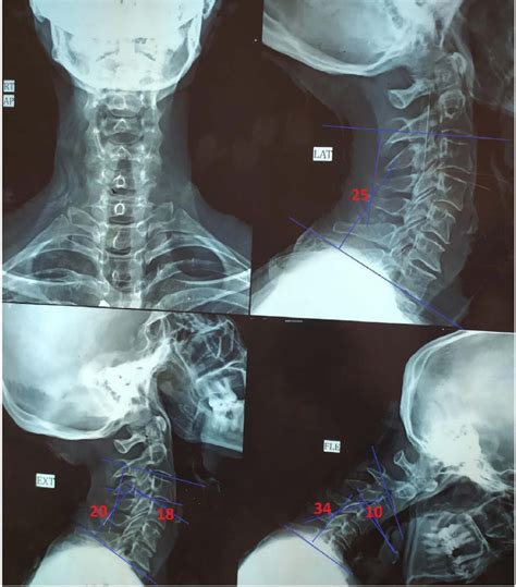 Preoperative Cervical Spine X Ray Ap Lateral Extension Flexion Of Download Scientific