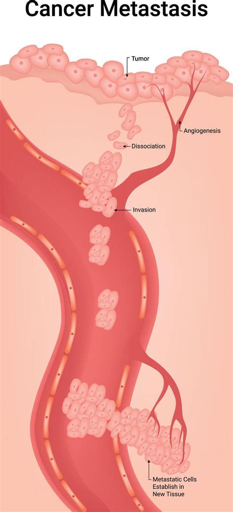 Cancer Metastasis Science Design Illustration Diagram 53257301 Vector