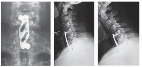 The Prevention Of Adjacent Segment Disease Associated With Cervical Spine Fusion Neupsy Key